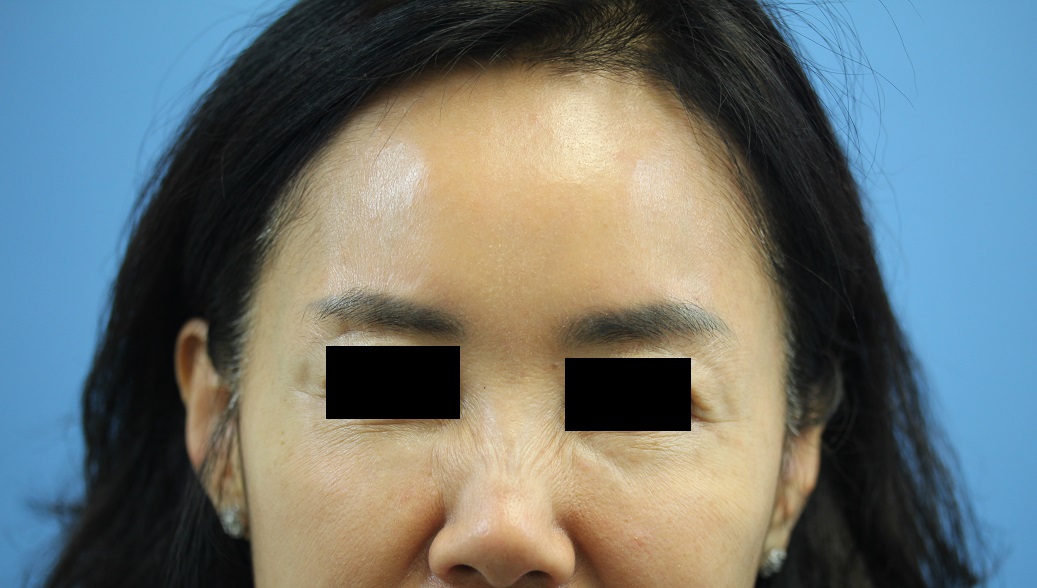 Facial Fillers & Botox Fairfax Virginia | Botox & Dysport Injections