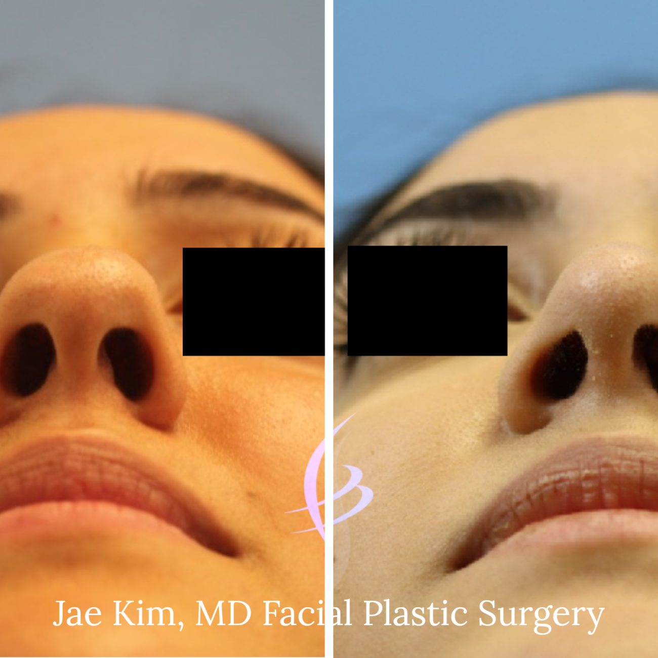 World-Class Rhinoplasty Fairfax VA | Nose Job Surgery Specialist
