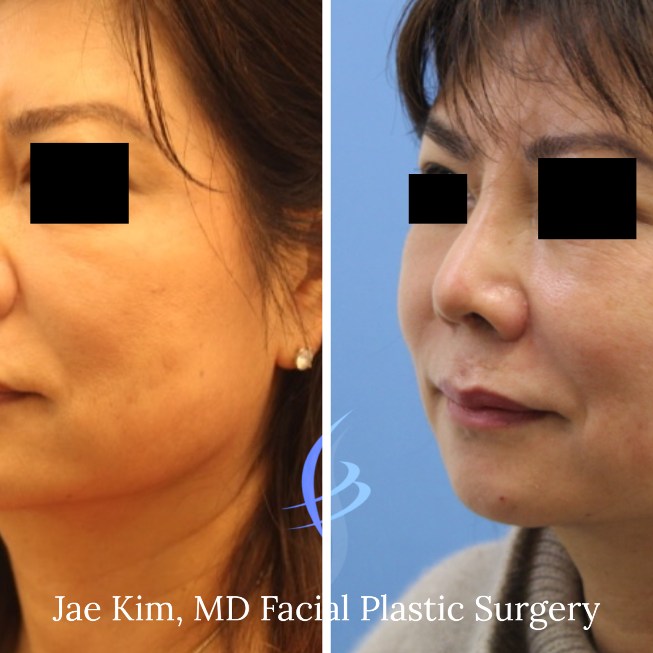 Asian Rhinoplasty - Jae Kim, MD