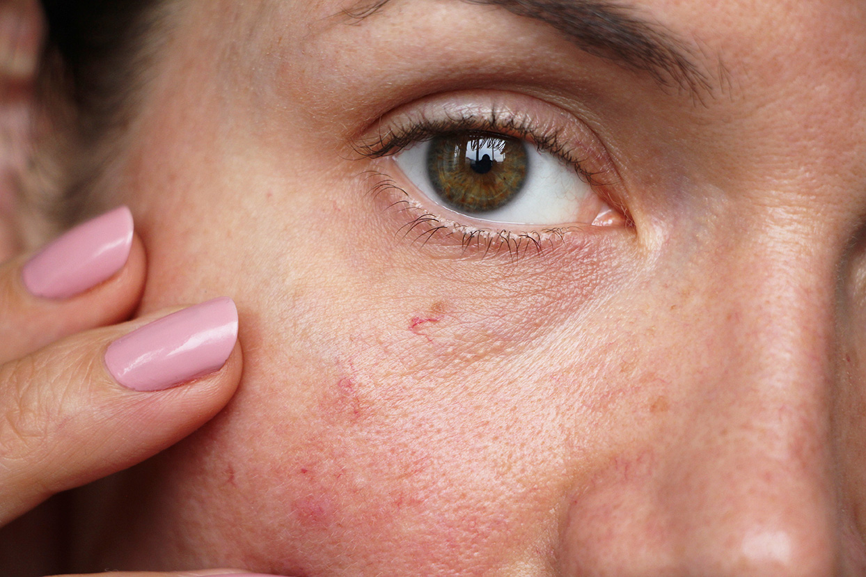 Red Spots On Chin Lupon gov ph