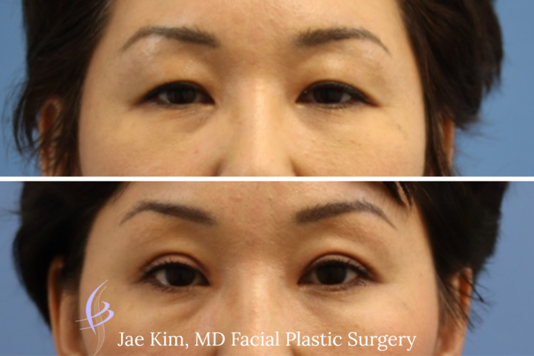 Asian Eyelid Surgery - Jae Kim, MD