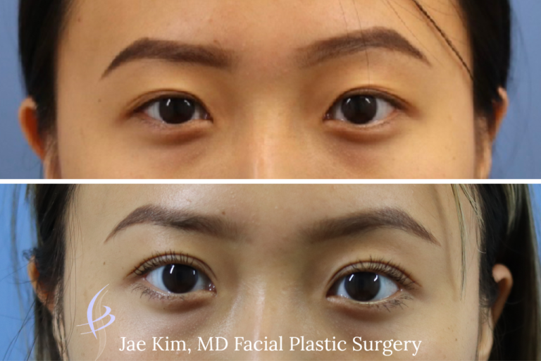 Asian Eyelid Surgery - Jae Kim, MD
