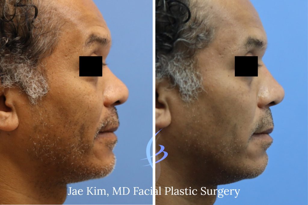 Injection Rhinoplasty - Jae Kim, MD