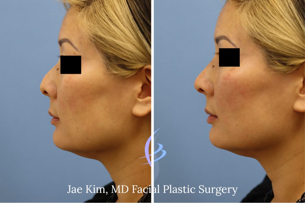 Injection Rhinoplasty - Jae Kim, MD