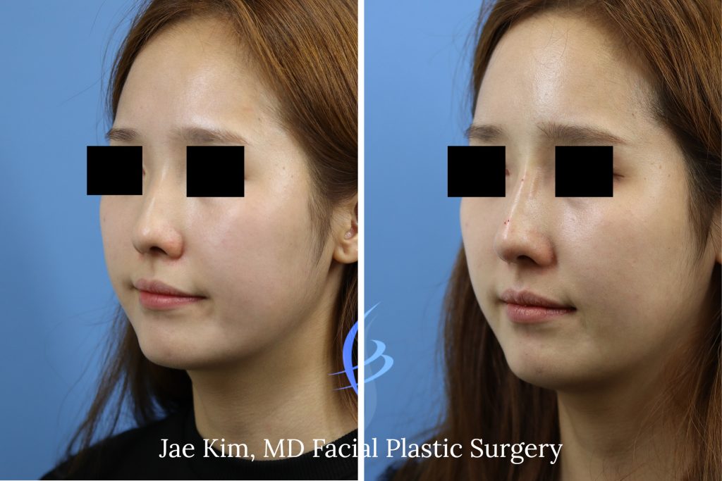 Injection Rhinoplasty - Jae Kim, MD