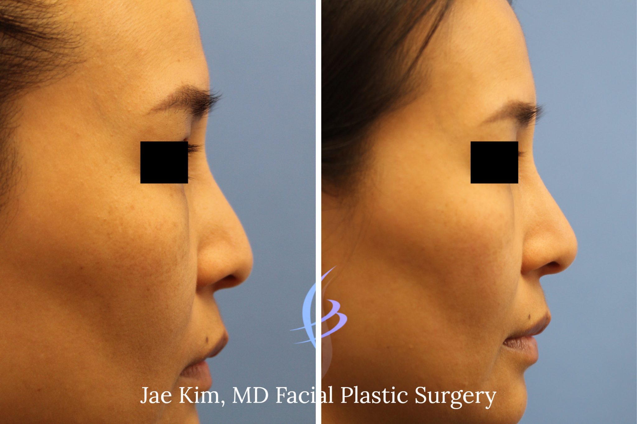 Injection Rhinoplasty - Jae Kim, MD