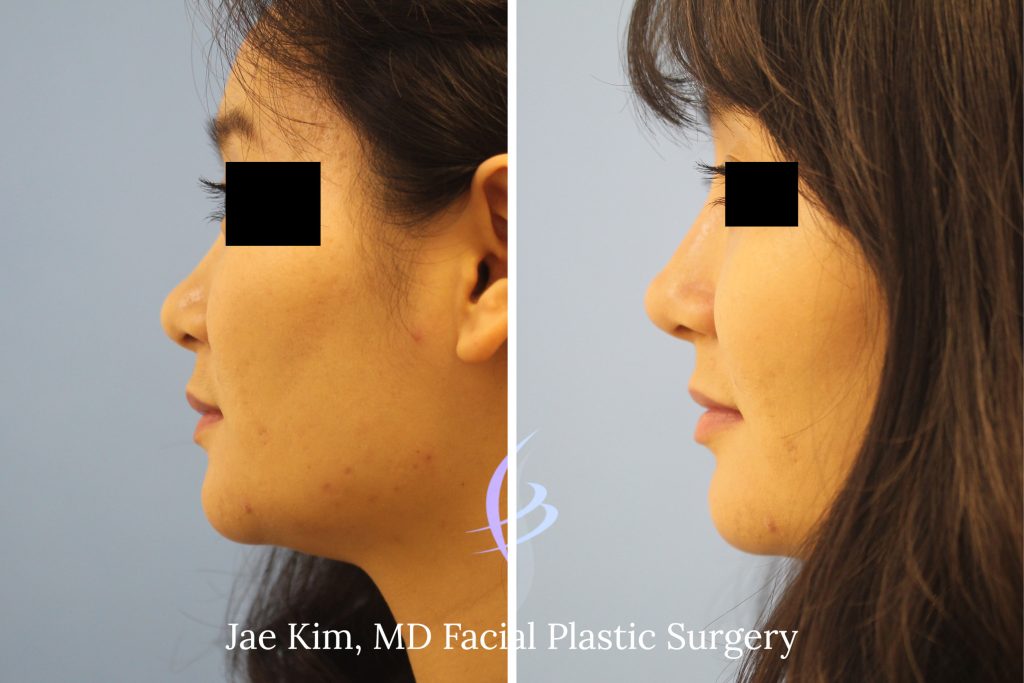 Injection Rhinoplasty - Jae Kim, MD