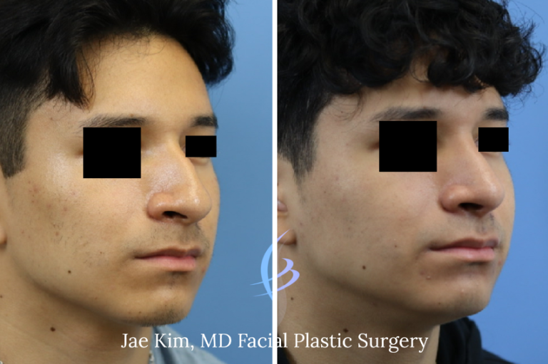 Rhinoplasty - Jae Kim, MD