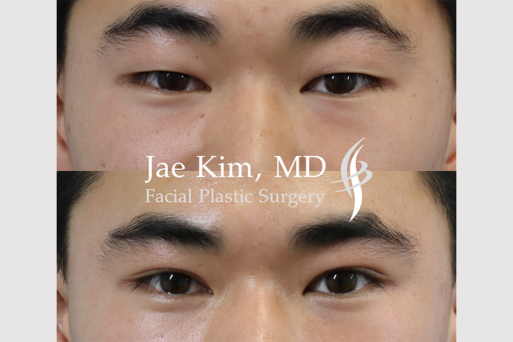 Asian Eyelid Surgery - Jae Kim, MD