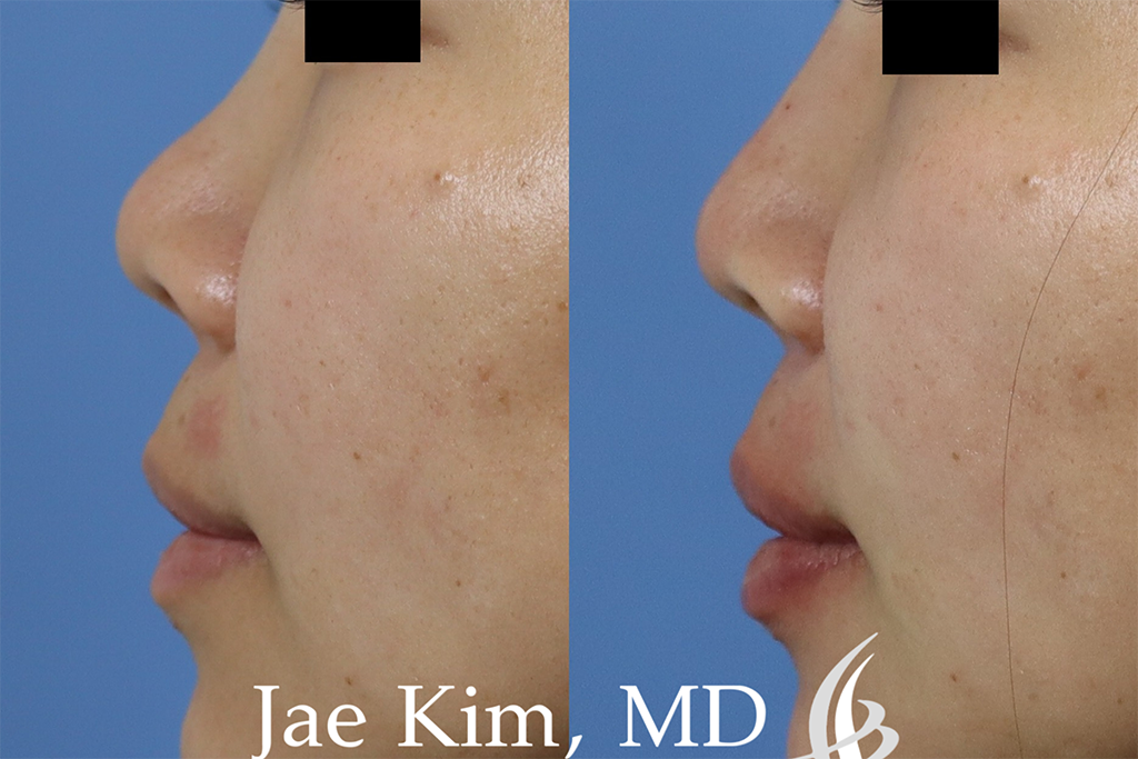 Injection Rhinoplasty - Jae Kim, MD