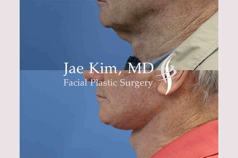 Face and Neck Lift - Jae Kim, MD
