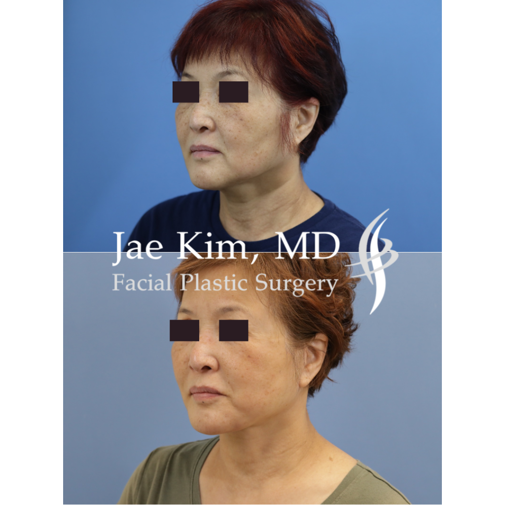 Face and Neck Lift - Jae Kim, MD