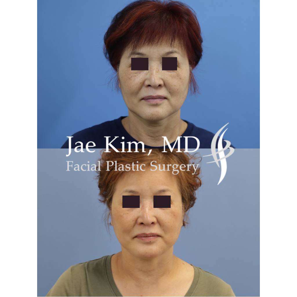 Face and Neck Lift - Jae Kim, MD
