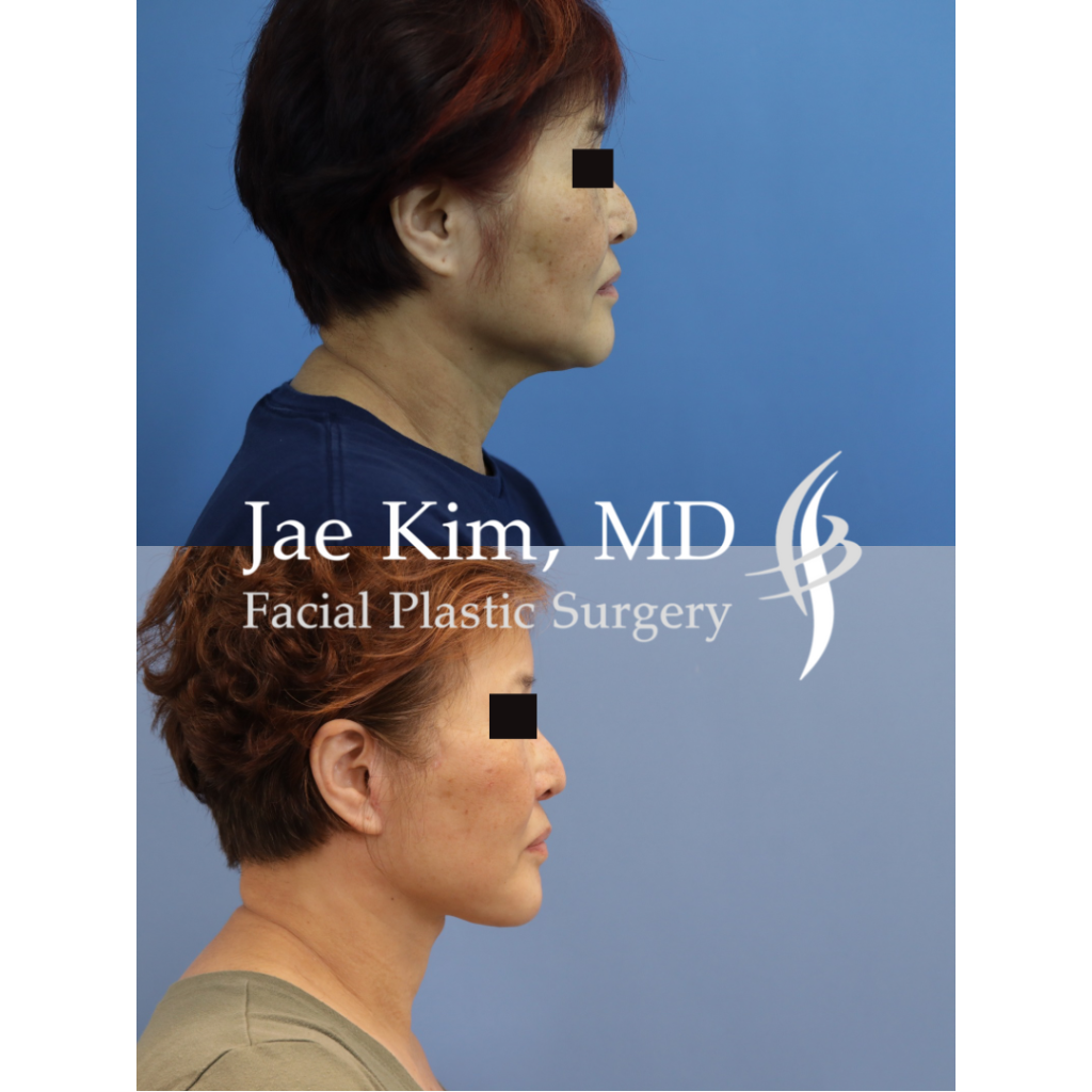 Face and Neck Lift - Jae Kim, MD