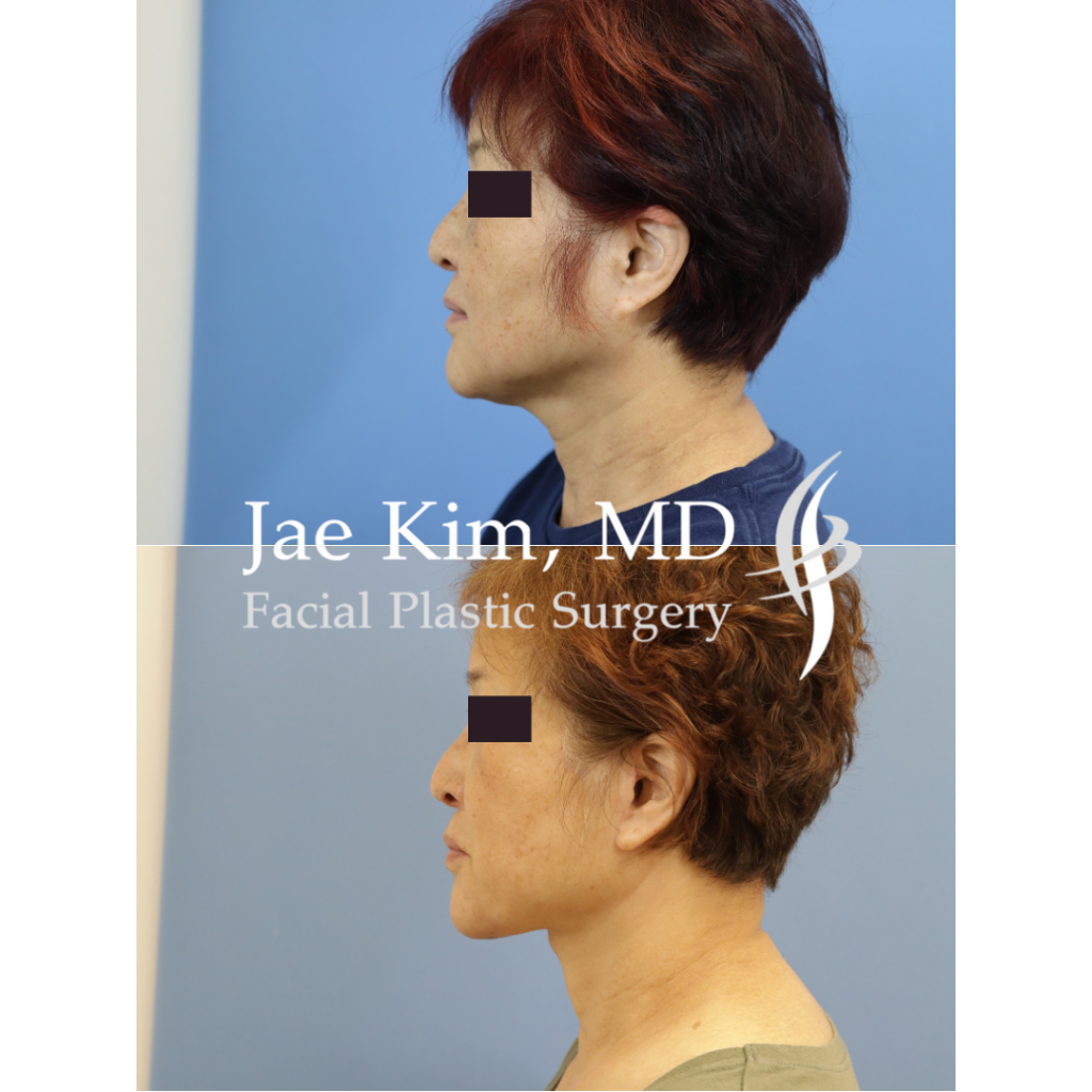Face and Neck Lift - Jae Kim, MD