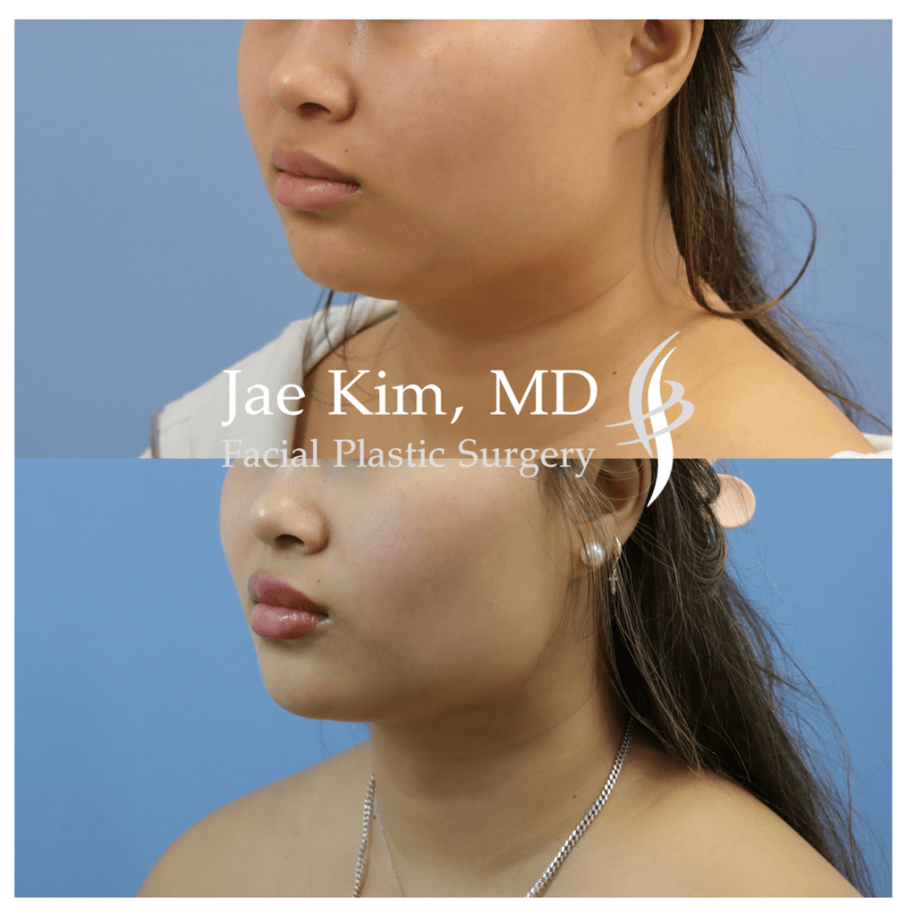 Liposuction for Chin and Neck Before-and-After Photos